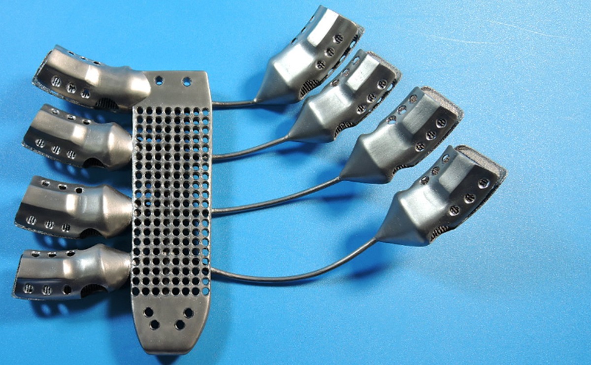 Cancer patient receives 3D printed rib cage - CSIRO