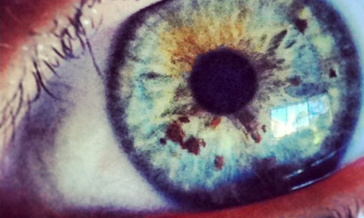 Golden eye: treating age-related macular degeneration with gold - CSIRO