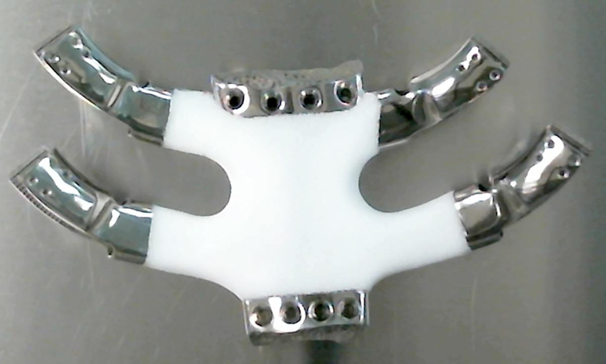 3D printed sternum in world-first surgery - CSIRO