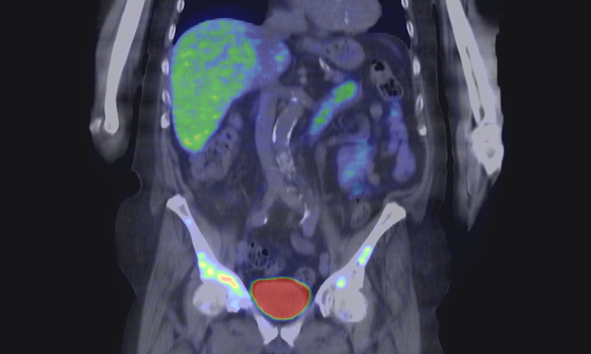 New $5m research project to treat ‘untreatable’ cancers - CSIRO