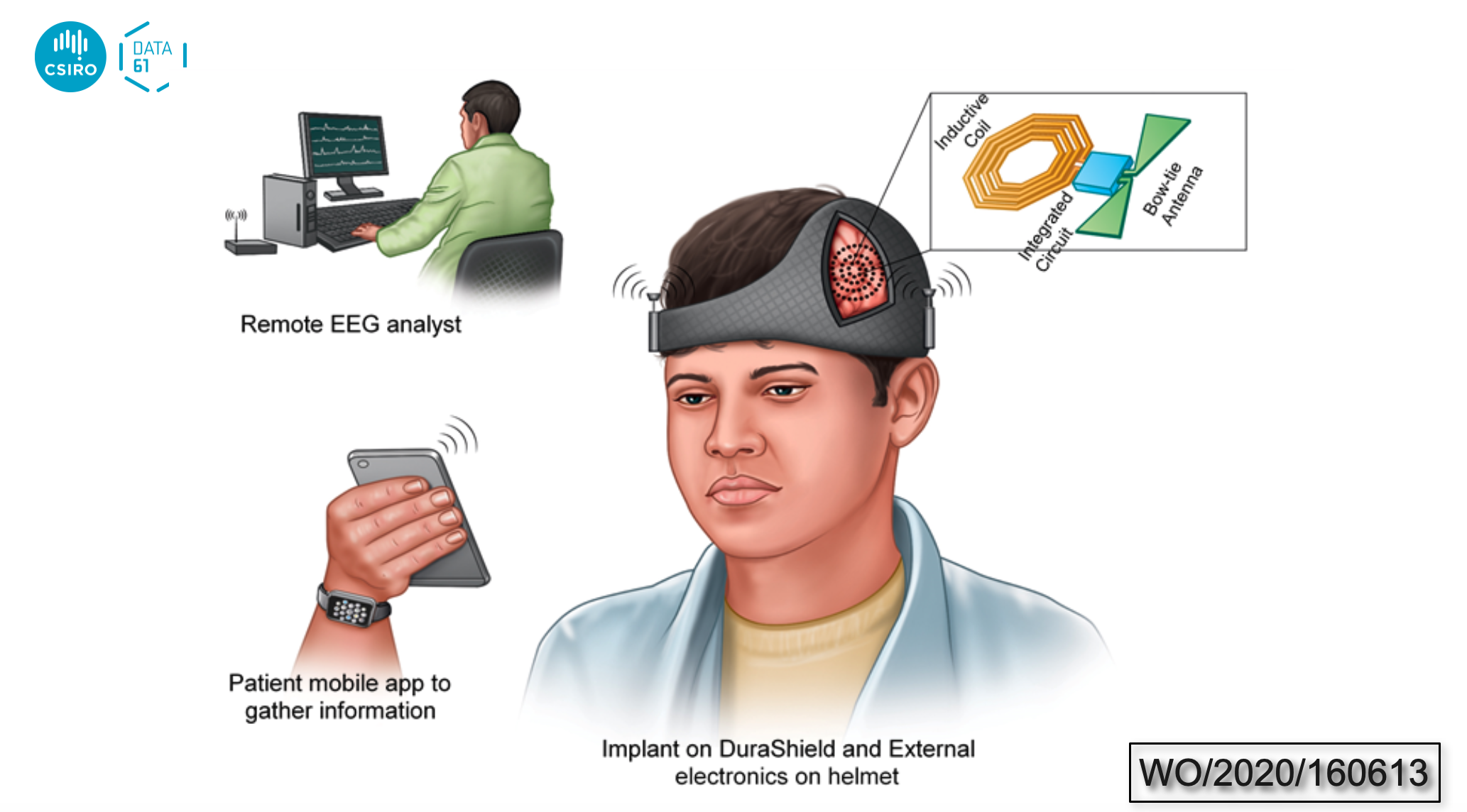 New implants to help detect and prevent brain seizures | Mirage News